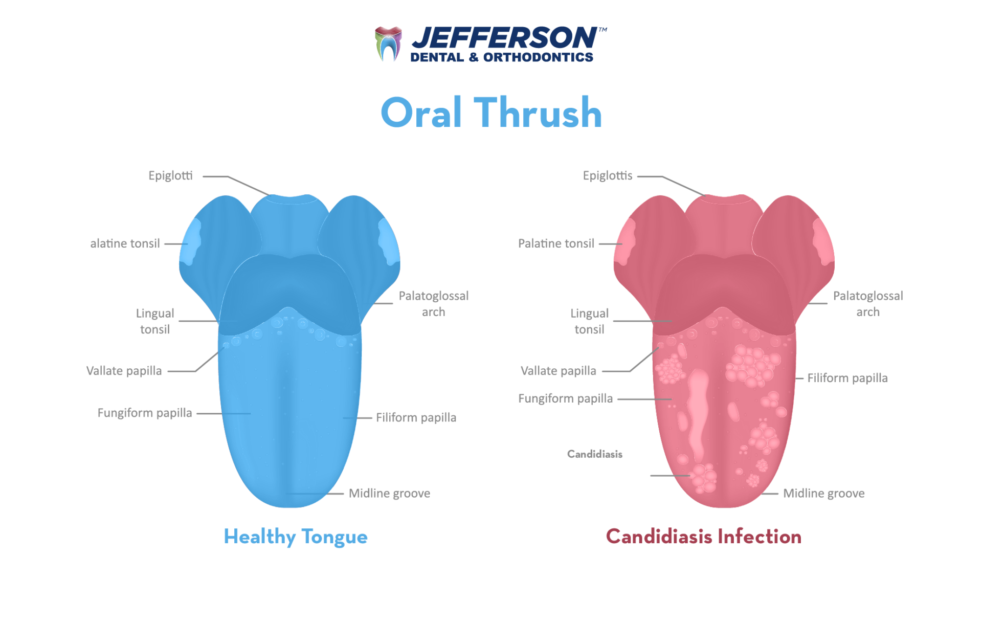 What Is Thrush? Symptoms, Causes, Diagnosis, Treatment, and Prevention ...